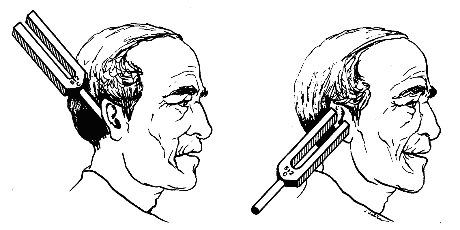 Weber Test and Rinne Test and Their Applications - Health Linear