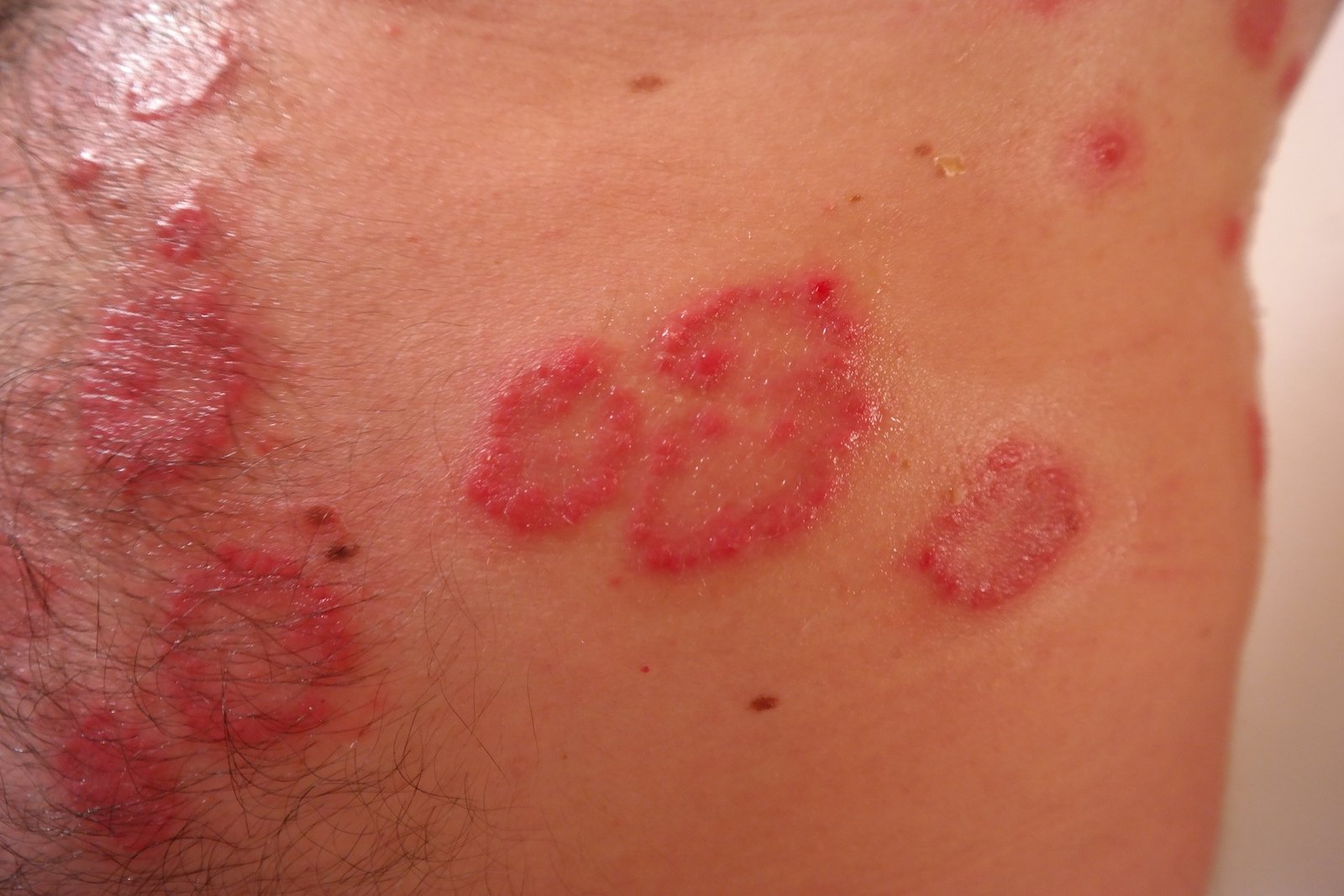 Hydroxocobalamin: Uses, Mechanism of Actions, and Deficiency Symptoms ...