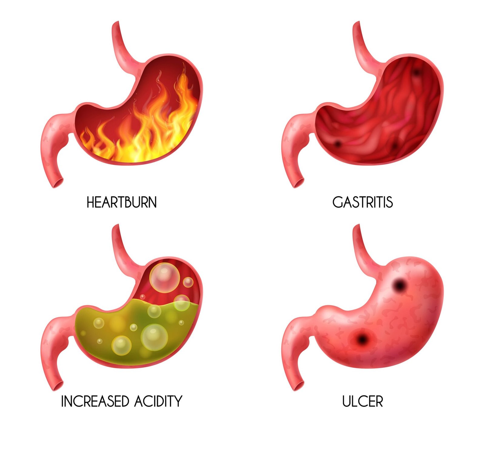 Nexium vs Prevacid: Which Provides Better Acid Control? – Health Linear