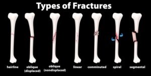 Stress Fracture vs Shin Splints: Battle of the Bones - Health Linear
