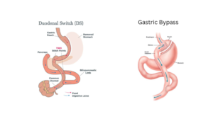 Duodenal Switch vs Gastric Bypass: Slimming Down – The Ultimate Battle ...